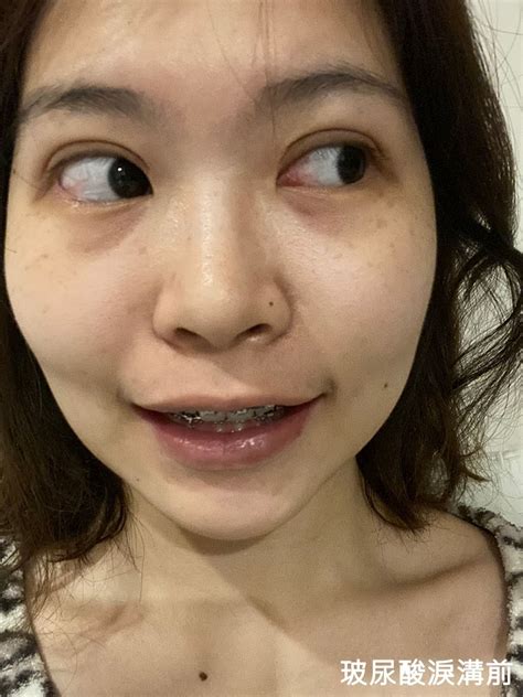 玻尿酸淚溝整形外科李兆翔醫師1cc輕鬆解決我的淚溝黑眼圈 佳思優整形醫美診所
