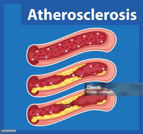 Pendidikan Ipa Anatomi Manusia Dan Perkembangan Aterosklerosis