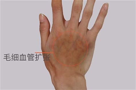 手背毛细血管图片医疗图片素材高清图片素材