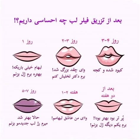 بعد از تزریق ژل لب چه حسی داریم؟ این تصویر روز های بعد از تزریق فیلر