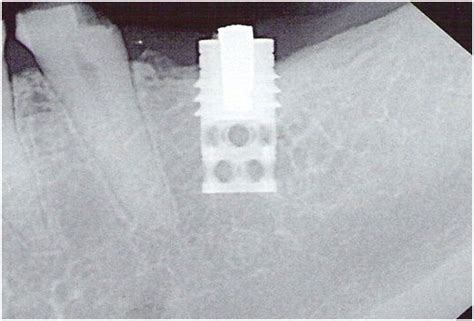 Socket Graft Putty™ Steiner Biotechnology™