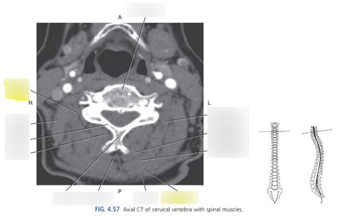 Axial Ct Diagram Quizlet