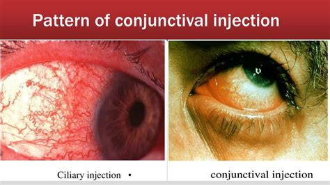 Injection Of Conjunctiva At Makayla Hampton Blog