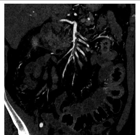 Figure 1 From Case Report Ultrasound Assisted Catheter Directed