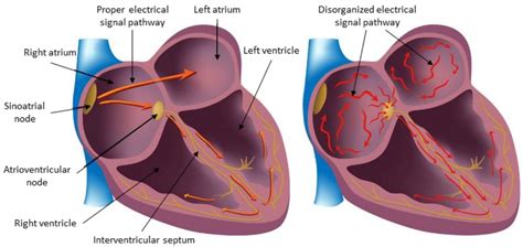 Auricle Atrium