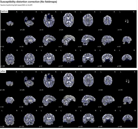 syn based sdc fieldmap less estimation fmriprep neurostars