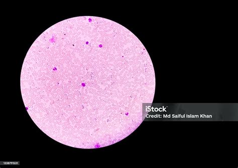 Hereditary Hemolytic Anemia Hemoglobin E Disease Is A Mild Inherited