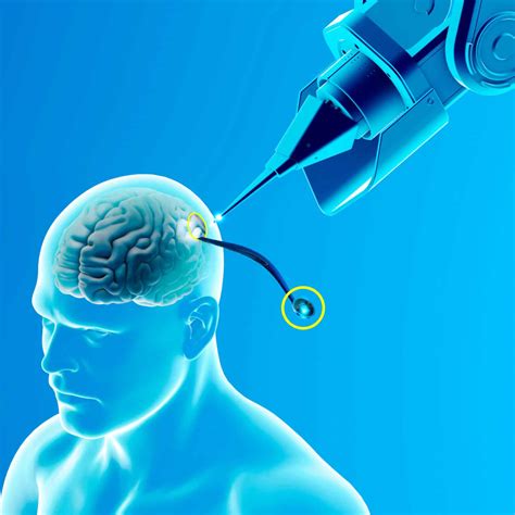 Neuralink La Première Puce Implantée Dans Un Cerveau Humain
