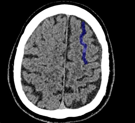 Sulcus Frontalis Superior Ars Neurochirurgica