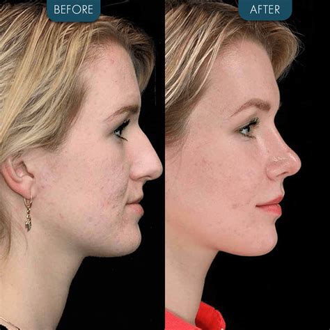 Chin Implant Before And After Zaren Health
