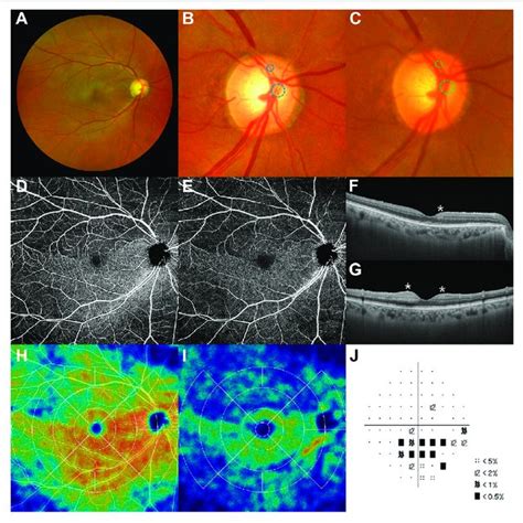 Branch Retinal Artery Occlusion After The First Dose Of The