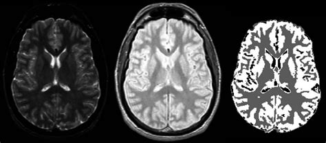 Illustration Of The Mri Segmentation Process Showing An Acquired