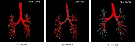 Extraction Of Pulmonary Airway In Ct Scans Using Deep Fully Convolutional Networks