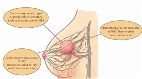 Case Report Triple Negative Breast Cancer Stage Iii