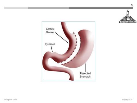 Complications Of Bariatric Surgery Pptx