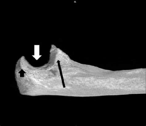 Sigmoid Notch