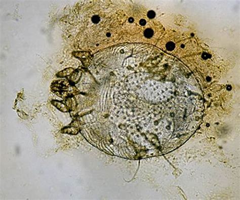 Scabies Signs Symptoms Otc Treatment And Home Remedies