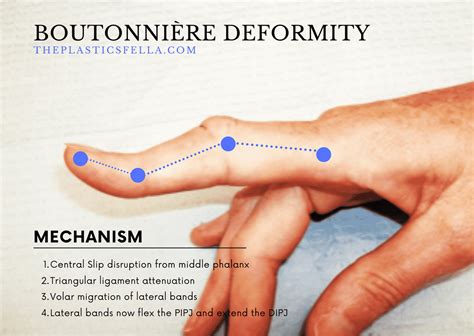 Swan Neck Deformity Cause Symptom Physiotherapy Treat