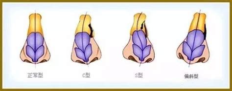 厦门隆鼻修复隆鼻后出现挛缩、歪斜的情况该怎么办？ 哔哩哔哩