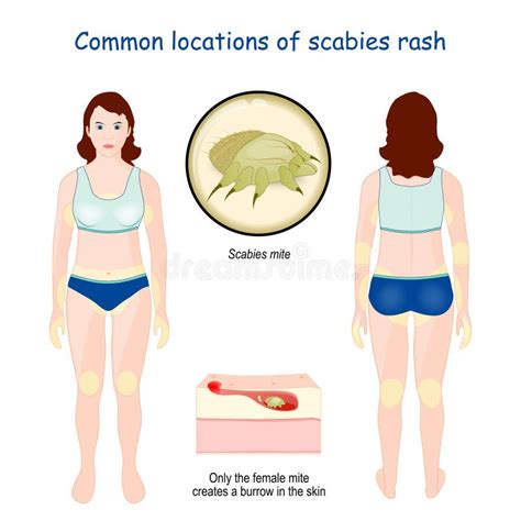 The Infection Of Scabies Itch Mite Stock Vector Illustration Of