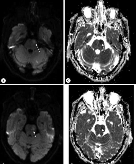 Diffusion Weighted B Images A B And Associated Apparent