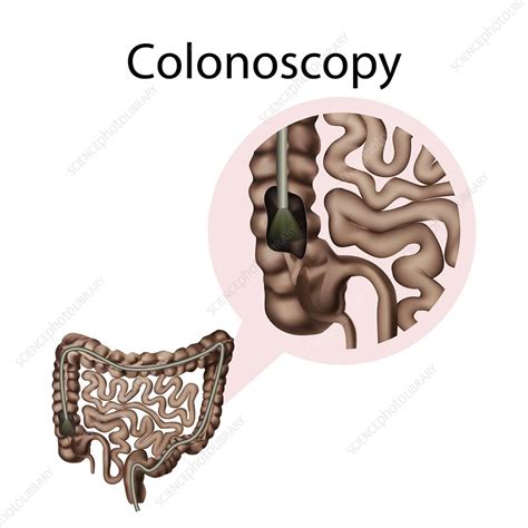 Colonoscopy Illustration Stock Image F0279742 Science Photo Library
