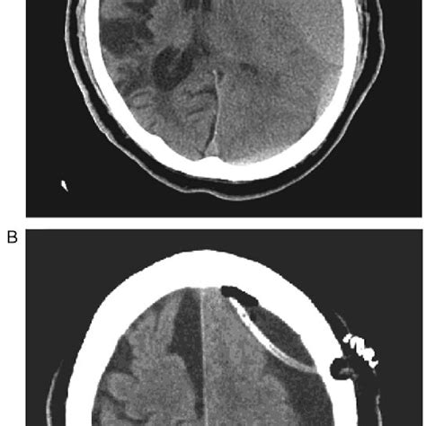 Head Computed Tomography Before A And After B Surgery Download