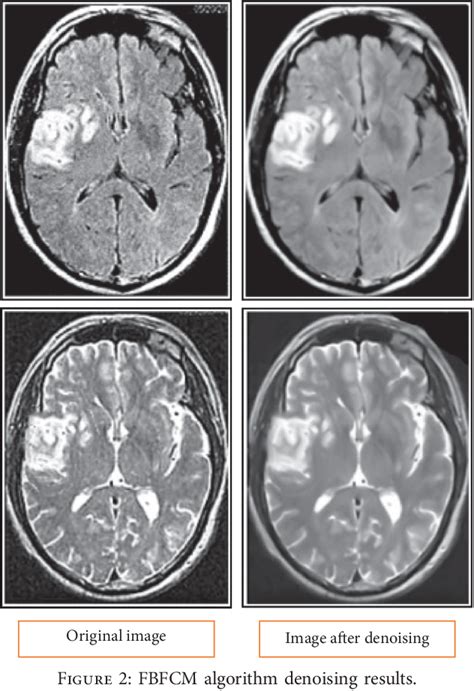 Figure 2 From Fuzzy Clustering Algorithm Segmented Mri Images In