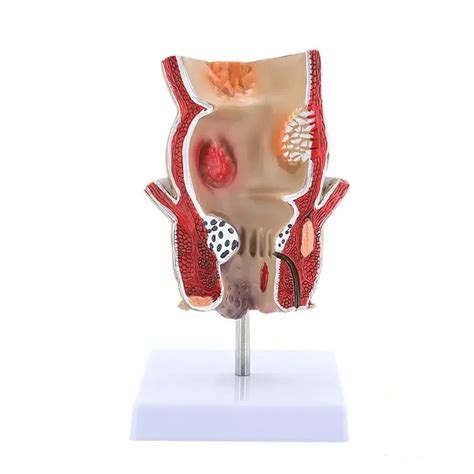 Kyrenmed Human Rectal Internal External Hemorrhoid Model Anorectal