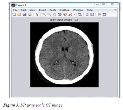 multimodal image fusion using an evolutionary based algorithm for brain