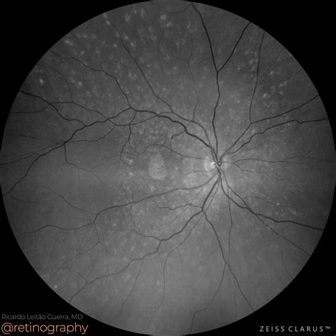 Geographic Atrophy Retinography