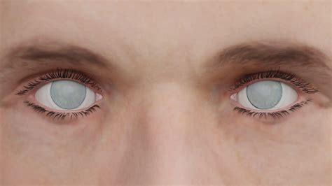 3d Models Of Posterior Corneal Dystrophy Voka