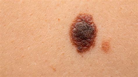 ¿qué Es El Cáncer De Piel Tipo Melanoma Medicina Básica