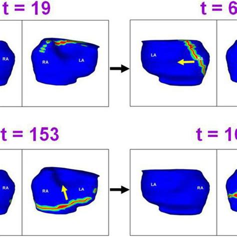 Macro Reentry In Persistent Af Propagating Wavefront Is Shown In