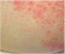 Diaper Rash