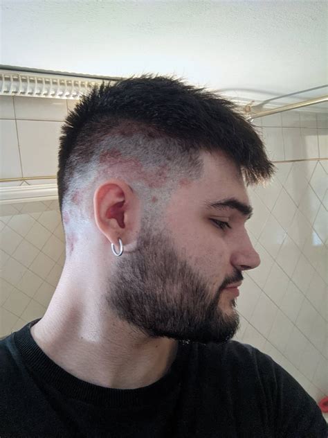 I Shaved My Hair Off Today Rpsoriasis