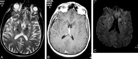 Cryptococcus Brain