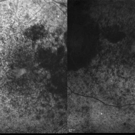 On Initial Evaluation Patient 2s Best Corrected Visual Acuity Was