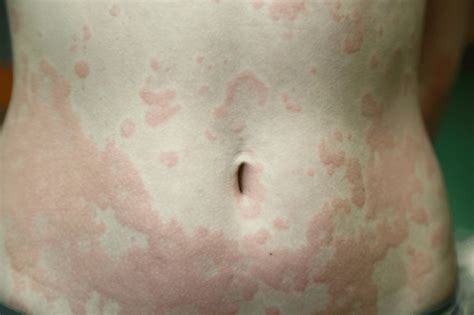 What Are The Different Types Of Skin Rashes