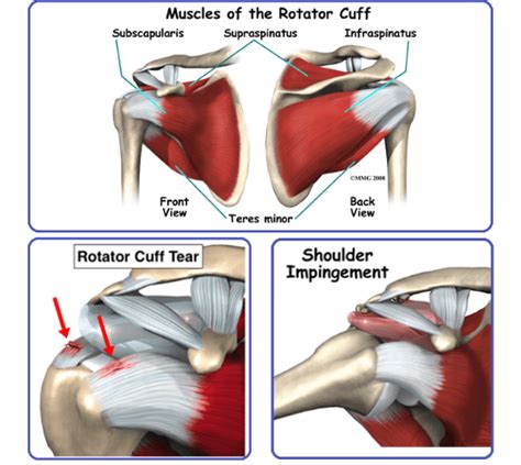Rotator Cuff Tear And Impingement
