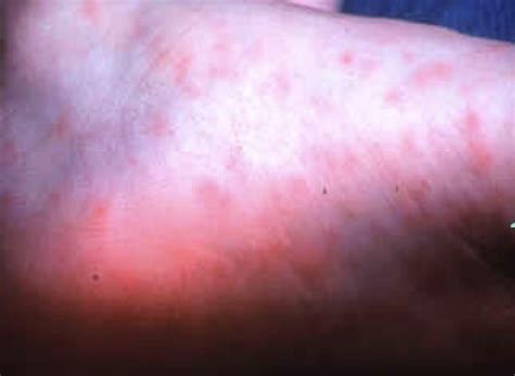 Rickettsia Ehrlichia Bartonella Leptospira Borreliam And Treponema