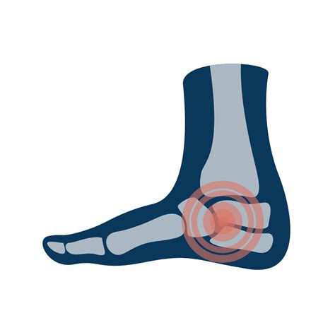 Sprain Vs Strain Whats The Difference Princeton Orthopaedic Associates
