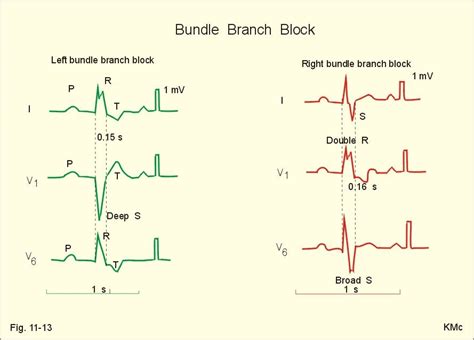 Right Bundle Branch Block Vs Left Bundle Branch Block Paramedic