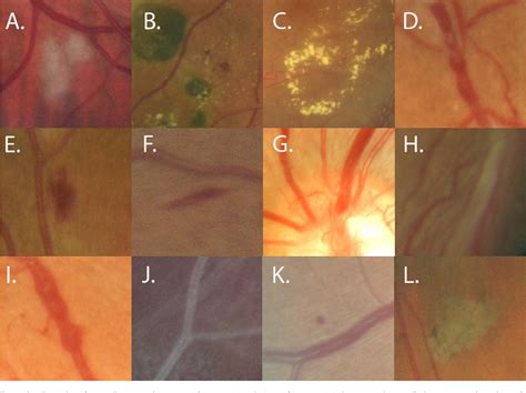 Figure 1 From Retinal Lesion Detection With Deep Learning Using Image Patches Semantic Scholar