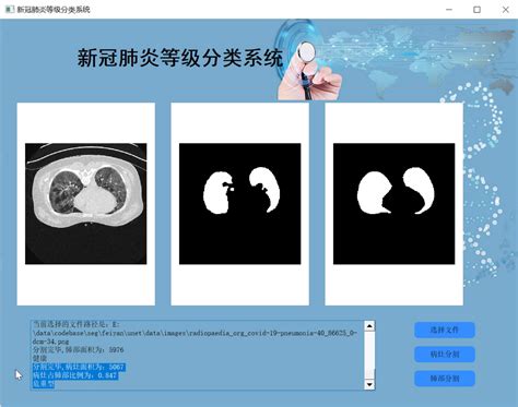 Python基于改进unet的新冠肺炎等级分割系统(源码&教程)unet Python源码 Csdn博客 Python基于改进unet的新冠肺炎等级分割系统(源码&教程)unet Python源码 Csdn博客