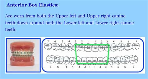 Anterior Box Elastics Orthodontics Dental Braces Dentistry