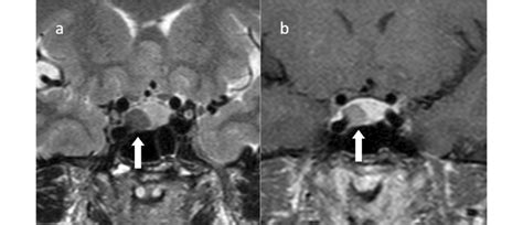 Growth Hormone Gh Producing Pitnetpituitary Adenoma Suspected To Be