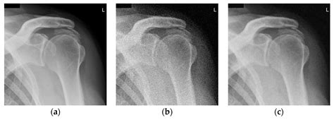 J Imaging Free Full Text Denoising Of X Ray Images Using The Adaptive Algorithm Based On