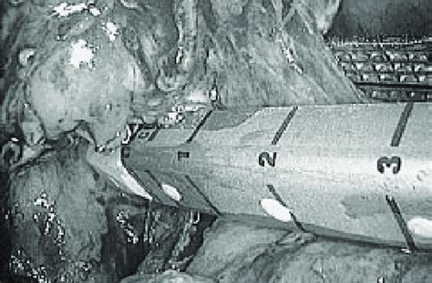 Stapling A Gangrenous Appendix Download Scientific Diagram