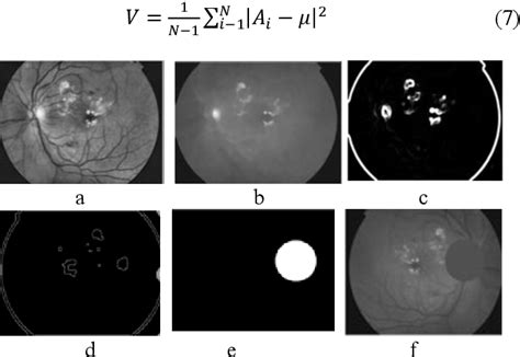 Figure 5 From Automated Retinal Hard Exudate Detection Using Novel